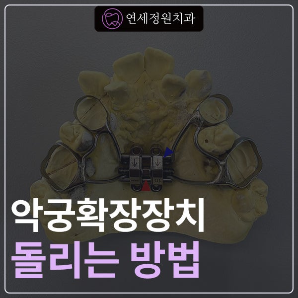 악궁확장장치(RPE, MARPE, MSE) 돌리는 방법 : 네이버 블로그