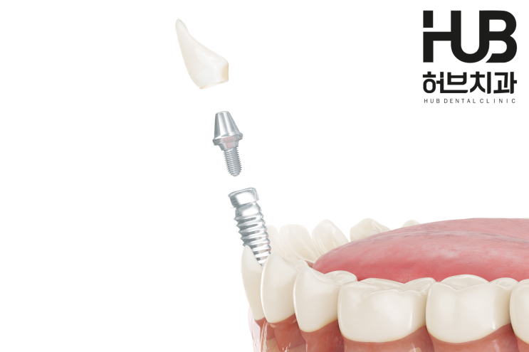 아산 임플란트 잘 하는 치과, 어떤 치과를 선택해야 오래 쓸 수 있을까? : 네이버 블로그