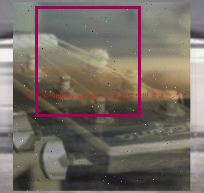 요도하열(Hypospadias) 원인과 치료 방법 알아보기 : 네이버 블로그