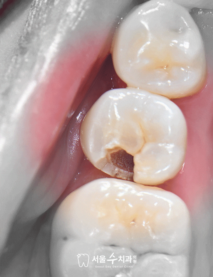 율량사천동 치과, 작아 보여도 깊다! 어금니 사이 충치 레진 치료 사례 : 네이버 블로그