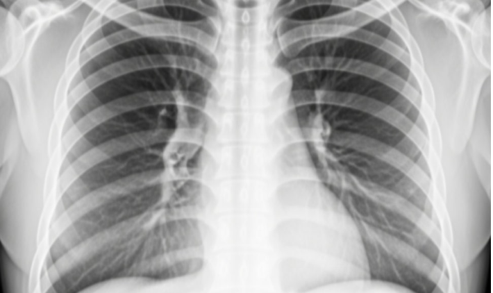 [질병] 폐부종-pulmonary edema : 네이버 블로그