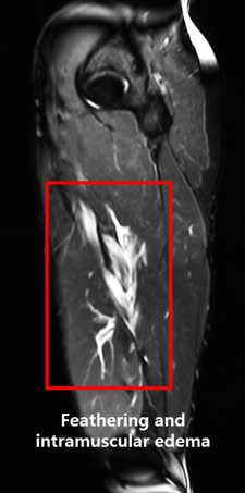 Case Review_75-스포츠 관련 부상으로 오른쪽 내전근 통증을 호소하는 31세 남자- Adductor injury ...
