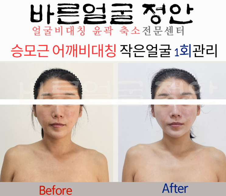 승모근 없애기 강남압구정 얼굴비대칭관리 바른얼굴정안 : 네이버 블로그