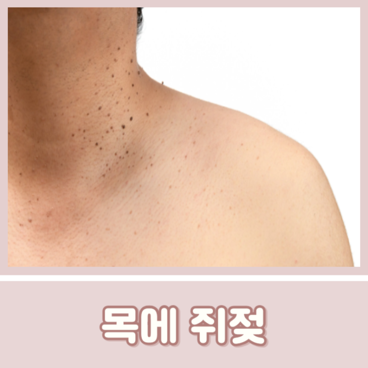 목에 쥐젖 생기는 원인 갑자기 늘어나는 이유와 집에서 관리할 때 주의사항 : 네이버 블로그