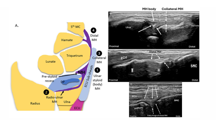 [논문] 손목 TFCC 초음파 해부학 정리 2 Meniscus Homologue, ECU subsheath : 네이버 블로그