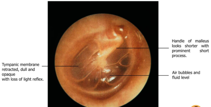 삼출성 중이염(Otitis media with effusion MEE) 검사소견 진단 치료 수술 합병증 : 네이버 블로그