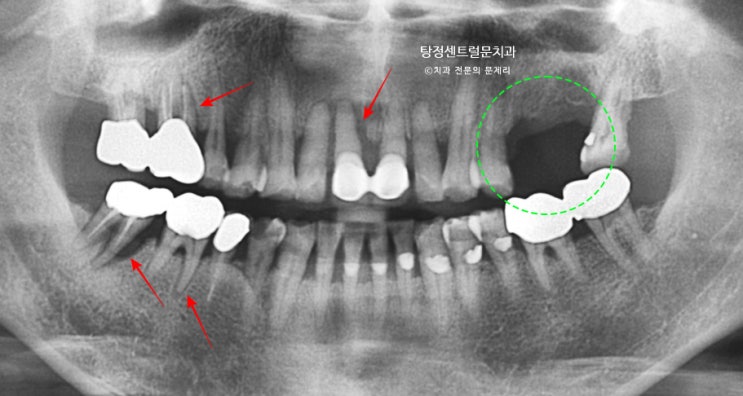 탕정치과 에서 알려드리는, 복합진료 과정 (임플란트, 엔도, 발치) : 네이버 블로그