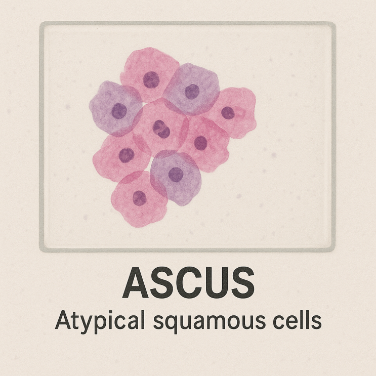 ASCUS관리, 비정형 세포 변화가 있을때 관리하는 방법! : 네이버 블로그