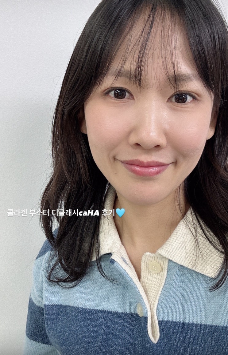 청담피부과 콜라겐 부스터 디클래시 CaHA 만족 후기 : 네이버 블로그