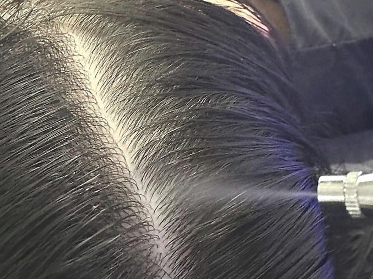 매일 빠지는 머리카락, 이수탈모 웰킨두피탈모센터에서 체계적으로 관리받아요! : 네이버 블로그