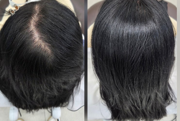 광주 앞머리 모류교정 후기 유명한 곳 : 네이버 블로그