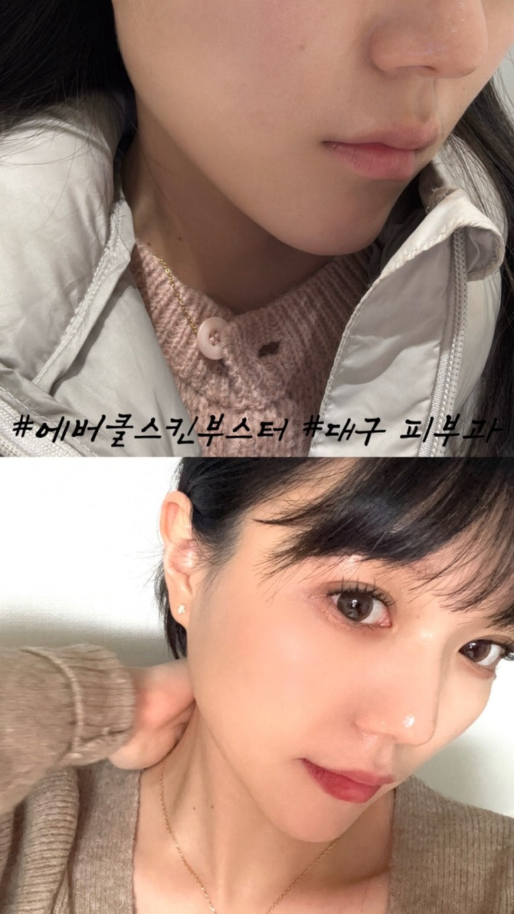 대구 달서구 피부과 에버클스킨부스터 시술 효과 솔직 후기 : 네이버 블로그