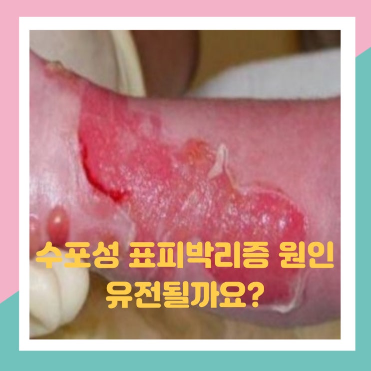 수포성 표피박리증 원인 치료 유전될까요? : 네이버 블로그