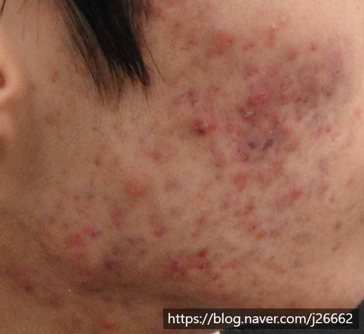 Blaney와 Cook에 의한 여드름 중증도에 대한 등급 분류시스템 (The grades for acne severity ...