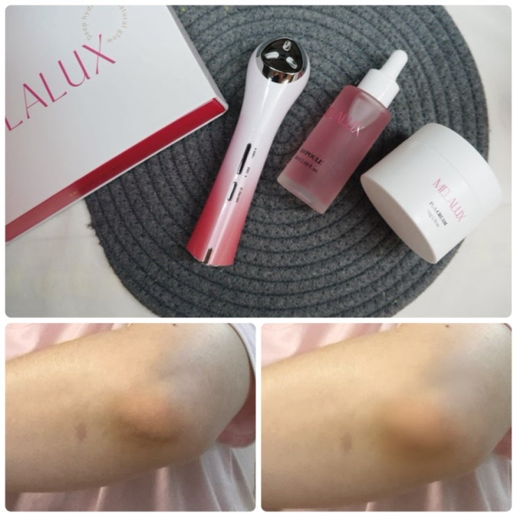 무릎 팔꿈치 착색고민 미백디바이스 멜라룩스 착색 토닝 디바이스 : 네이버 블로그