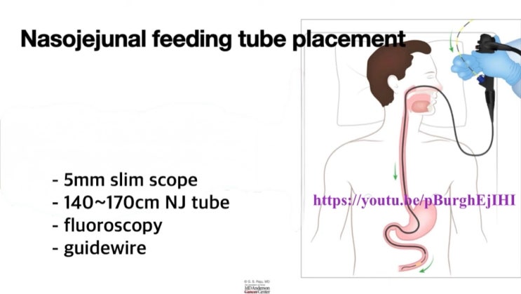 endoscopic nasojejunal tube (NJ tube) placement : 네이버 블로그
