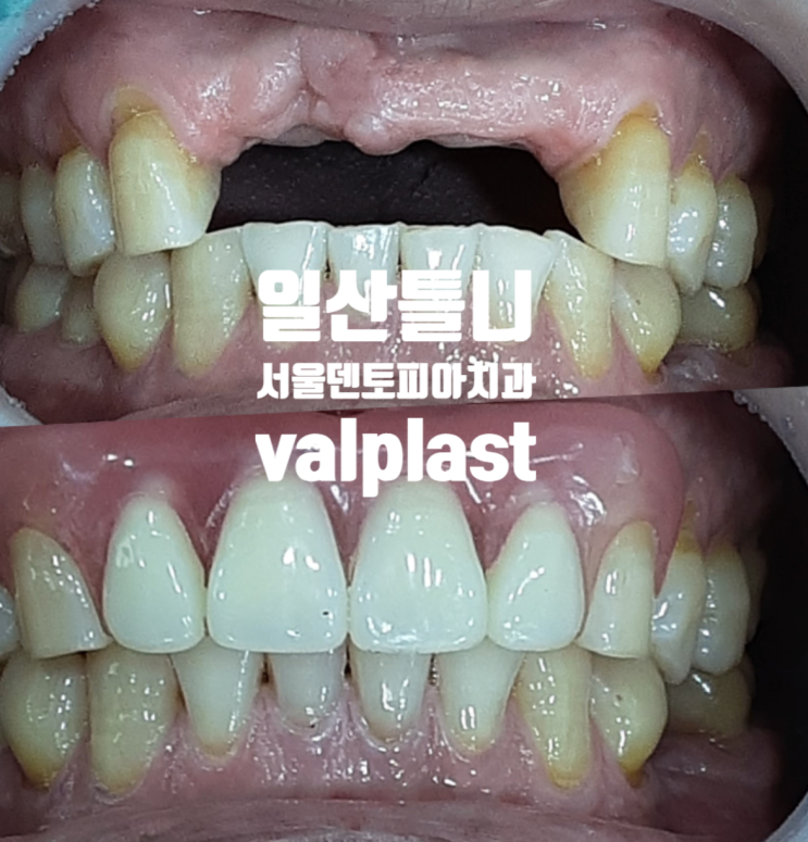 일산 틀니 잘하는 서울덴토피아치과 티 안나는 자연스러운 부분틀니! "valplast" : 네이버 블로그