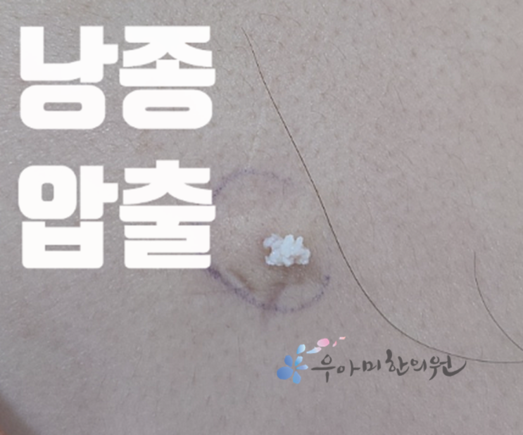 허벅지 모낭염, 운동할 때마다 같은 자리에 올라온다면? : 네이버 블로그