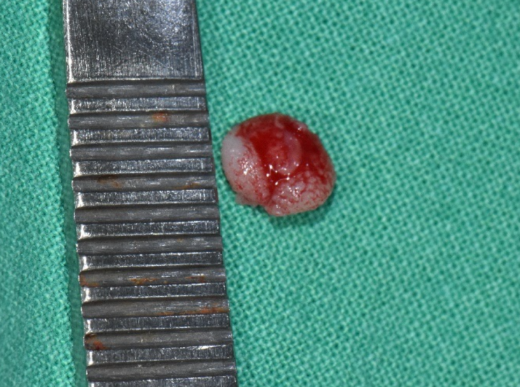 입속에 생기는 편평 유두종(Squamous Papilloma) : 네이버 블로그