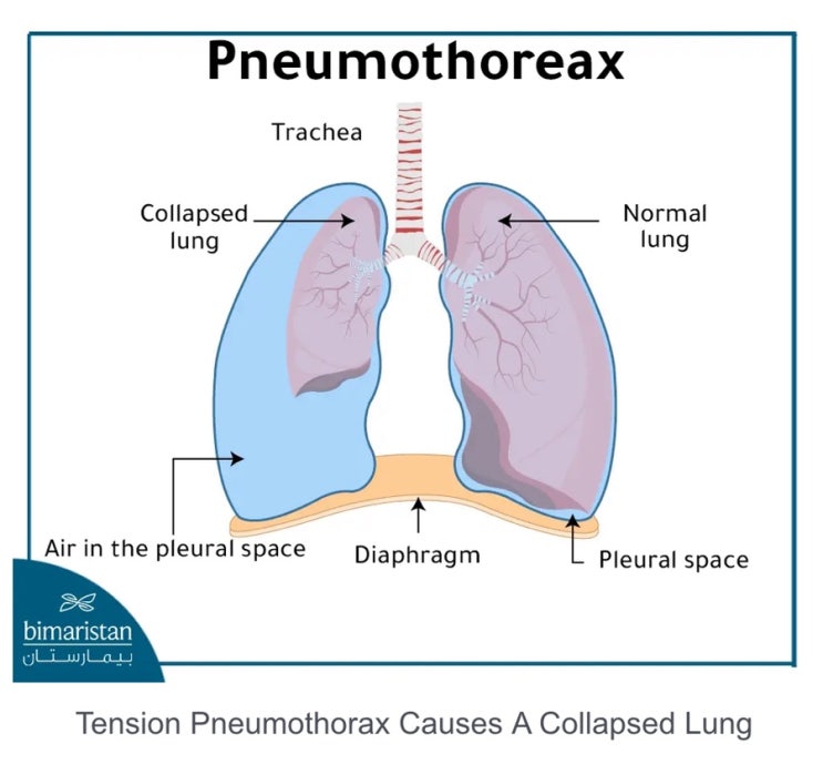 Pneumothorax 기흉, Emphysema 폐기종 간호, 흉부 X-ray 해석, ICC 관리 : 네이버 블로그