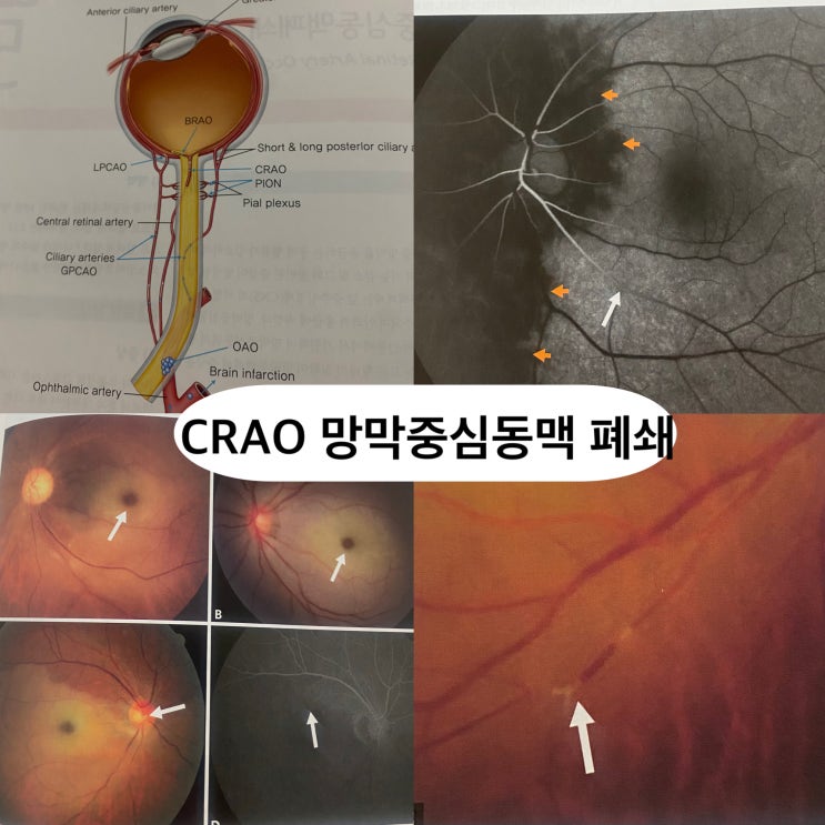 Central Retinal Artery Occlusion (CRAO, 망막중심동맥 폐쇄) — 눈의 뇌졸중(Eye stroke ...