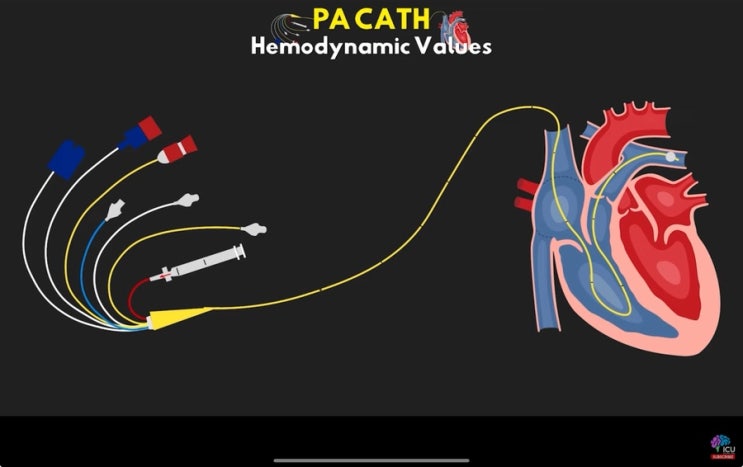 CVC 중심정맥관) Pulmonary Artery Catheter 폐동맥 카테터 뭘까? Cardiac Index, Cardiac ...