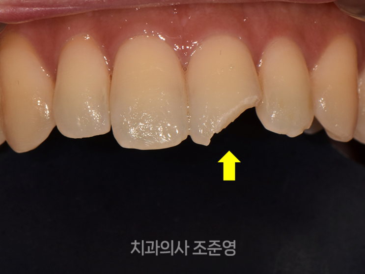 이빨 살짝 깨짐, 이가 깨졌어요? 이렇게 대처하세요! : 네이버 블로그