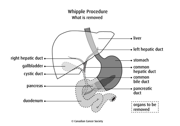 Whipple/distal/total pancreatectomy : 네이버 블로그