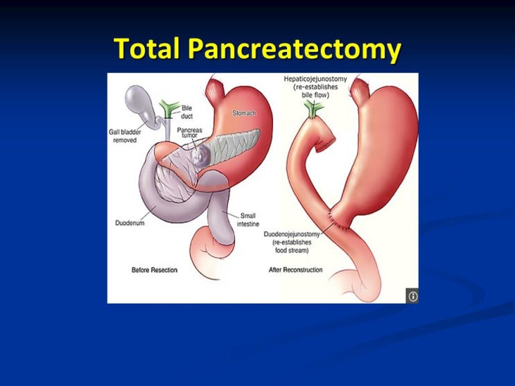 췌장전절제술(total pancreatectomy) : 네이버 블로그
