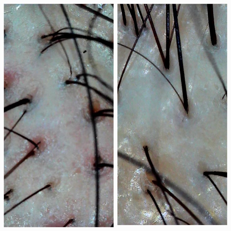 📌두피 타입은 평생 고정일까? 바뀌는 이유 : 네이버 블로그