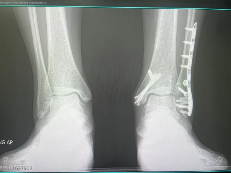 발목골절 치료기 - 약 8개월 후(핀제거 수술) : 네이버 블로그