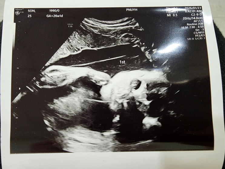 일란성쌍둥이/26주1일(260123)_양산부산대학교병원 ∞ 초음파, 임신성당뇨검사, 빈혈검사 : 네이버 블로그