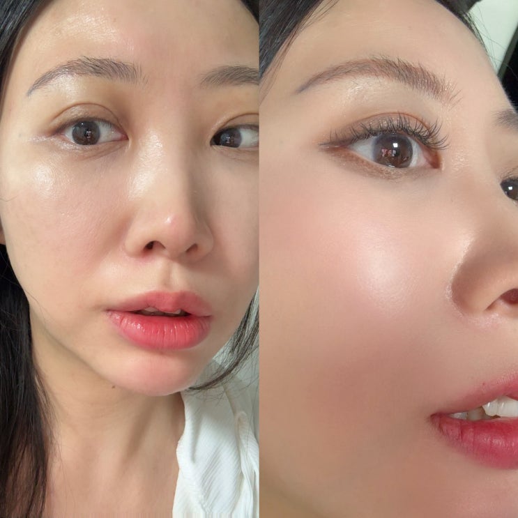 청량리피부과 스컬피오 리프팅레이저 후기 안아픈리프팅 추천 솔직후기 : 네이버 블로그