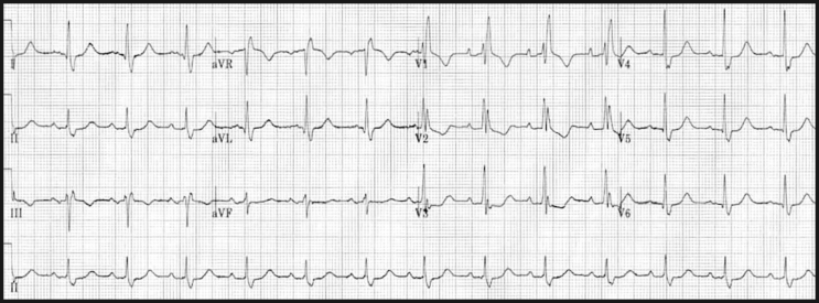 RBBB 인데... STEMI 를 어떻게 구별하지? : 네이버 블로그