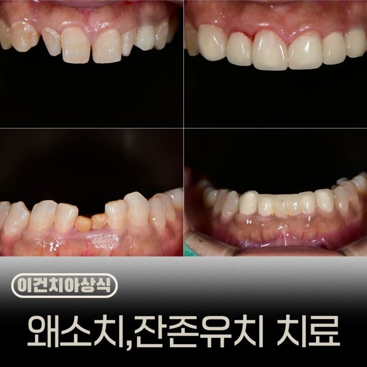 수원치과에서 왜소치(작은치아) 치료 케이스 : 네이버 블로그