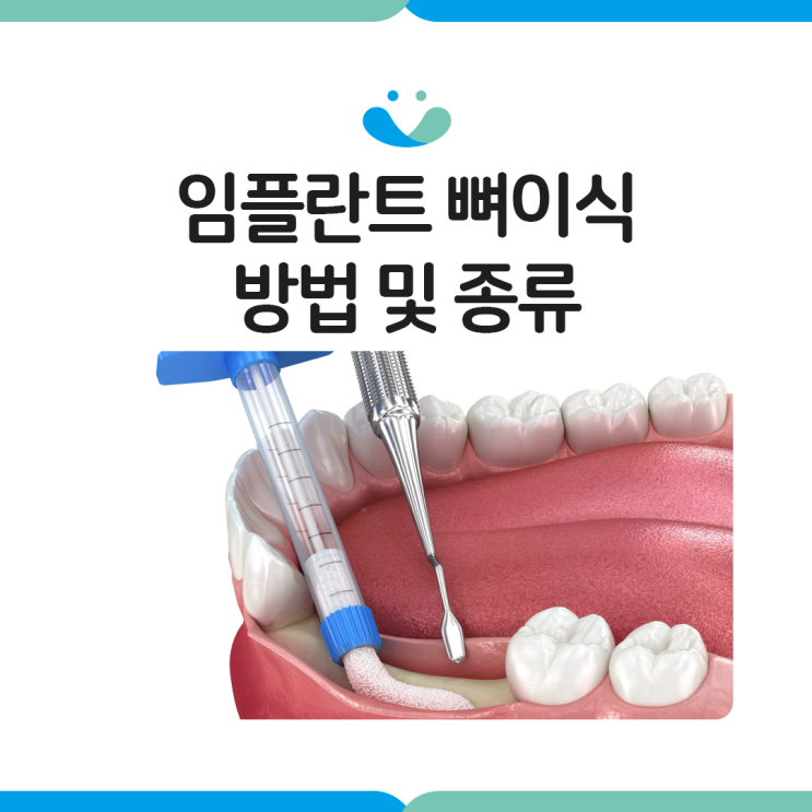 인천검단치과 | 임플란트 뼈이식 방법, 어떤 경우에 필요할까요? : 네이버 블로그