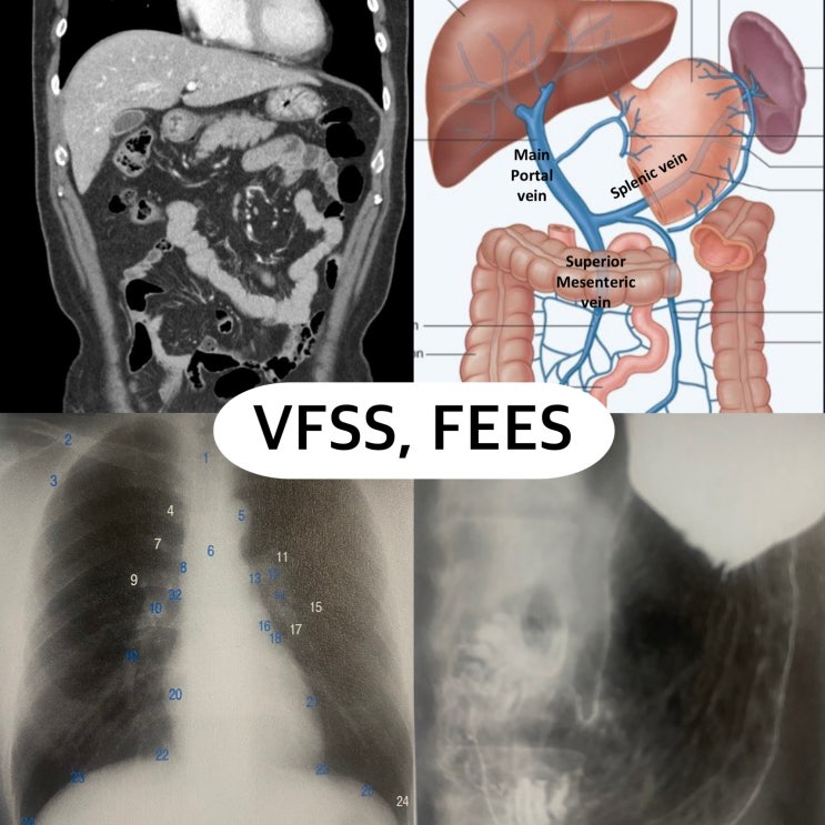 연하장애(dysphagia) 총정리｜평가기준, VFSS·FEES 비교 : 네이버 블로그