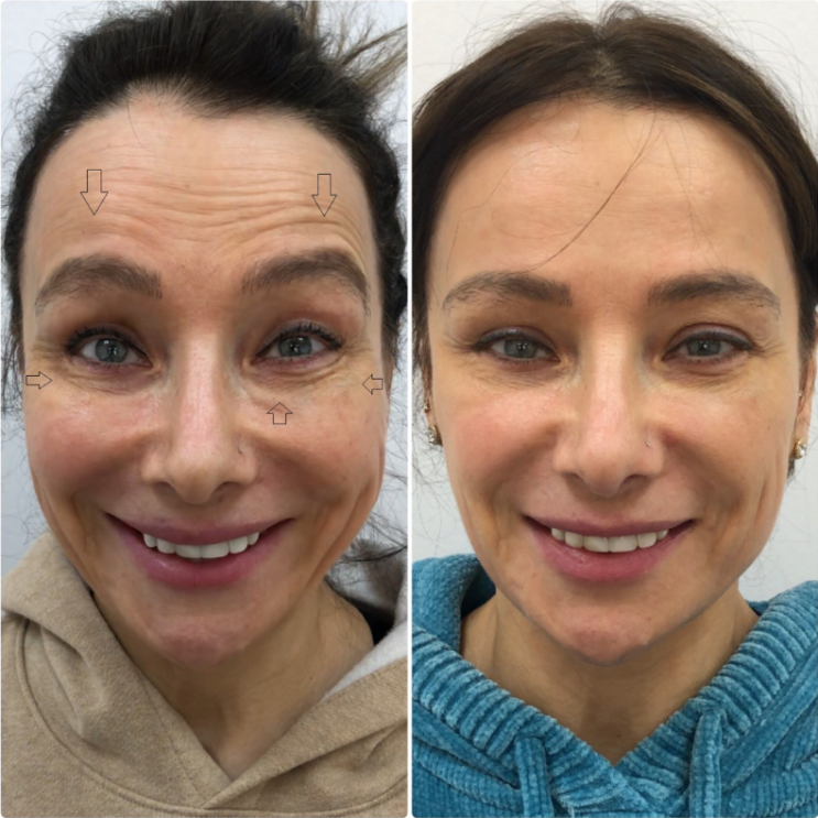 웃을 때 더 부자연스러워지는 midface, 혹시 FOS일까?(초음파로 찾고, hyaluronidase로 푼 facial ...