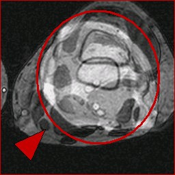 MRI artifact : 네이버 블로그