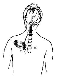 Interscapular pain of cervical origin : 네이버 블로그