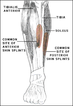 Shin Splints : 네이버 블로그