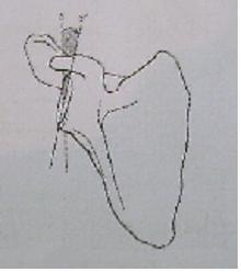 Normal scapular alignment(정상 견갑골 정렬) : 네이버 블로그