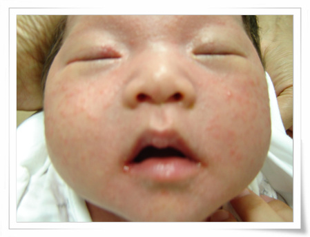 Neonatal cephalic pustulosis : 네이버 블로그