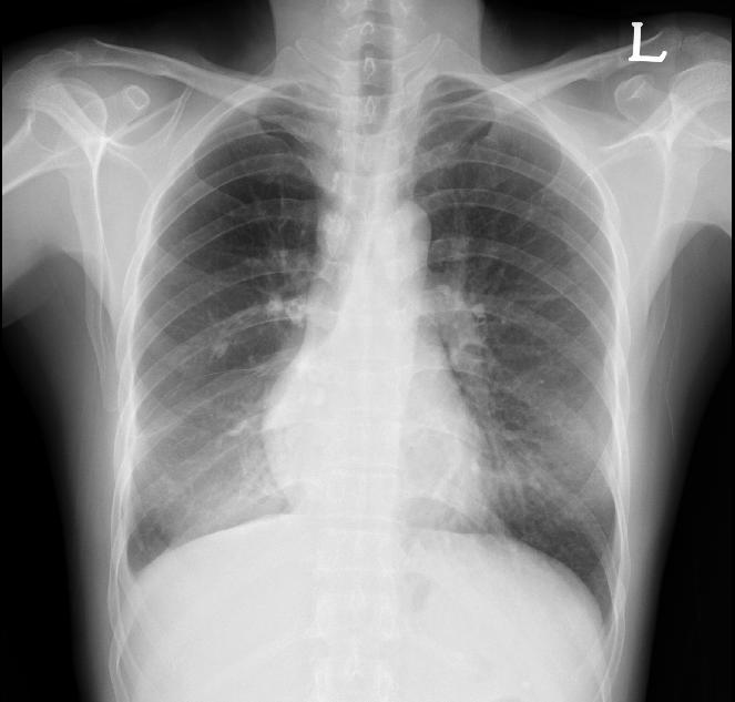 Chest PT의 효과 : 네이버 블로그