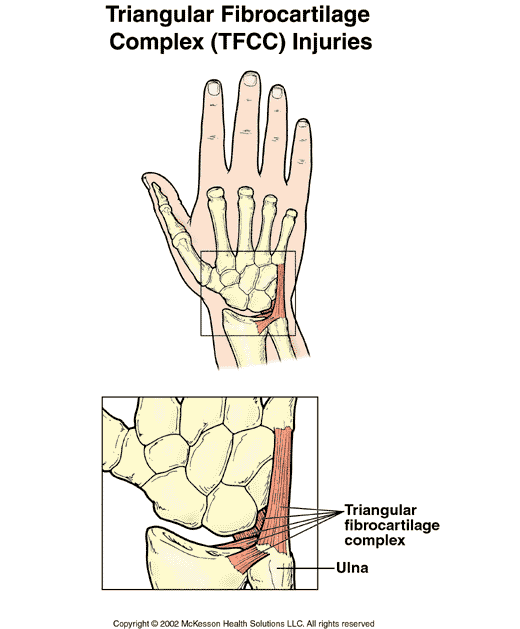 손목이 아파요!(3) - TFCC injury : 네이버 블로그
