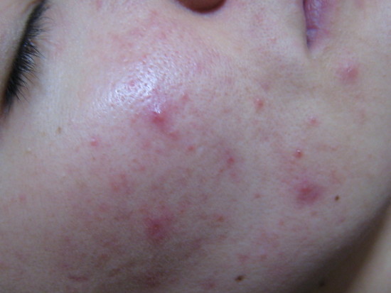 AC FORTE 임상결과(10일후기) : 네이버 블로그