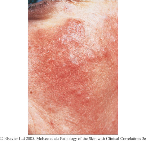 [병리] 다형광발진 (Polymorphous Light Eruption) : 네이버 블로그