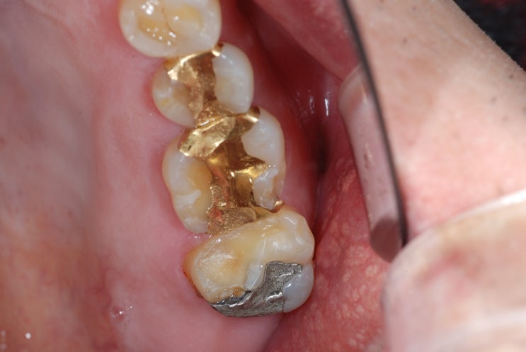 MOD inlay의 최후 - 덴트포토에서 발췌 (감사맨님 글 제공) : 네이버 블로그