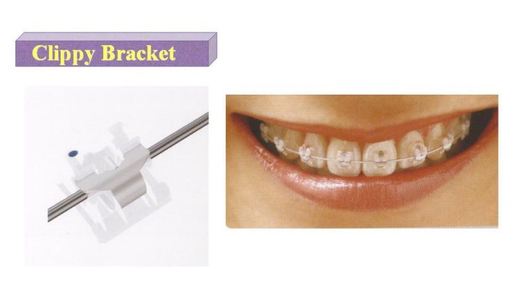 [치아교정]자가결찰 브라켓-(3) 클리피 브라켓( Clippy Bracket ) : 네이버 블로그