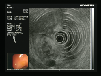 EUS - Uncinate process mass : 네이버 블로그